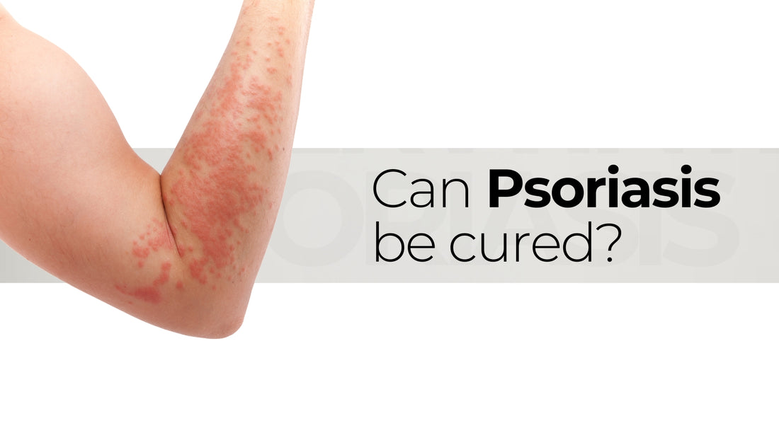 What is Psoriasis? Causes | Symptoms | Cure | Hard Water impact on ...